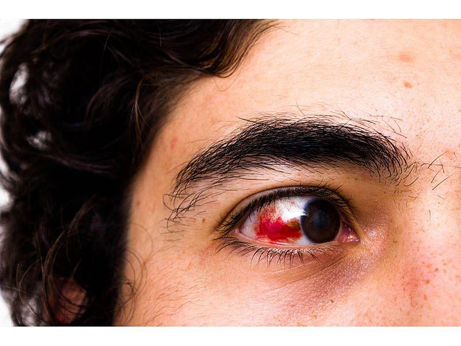Blood In The Eye Consumer Health News HealthDay Blood In The Eye Consumer Health News HealthDay