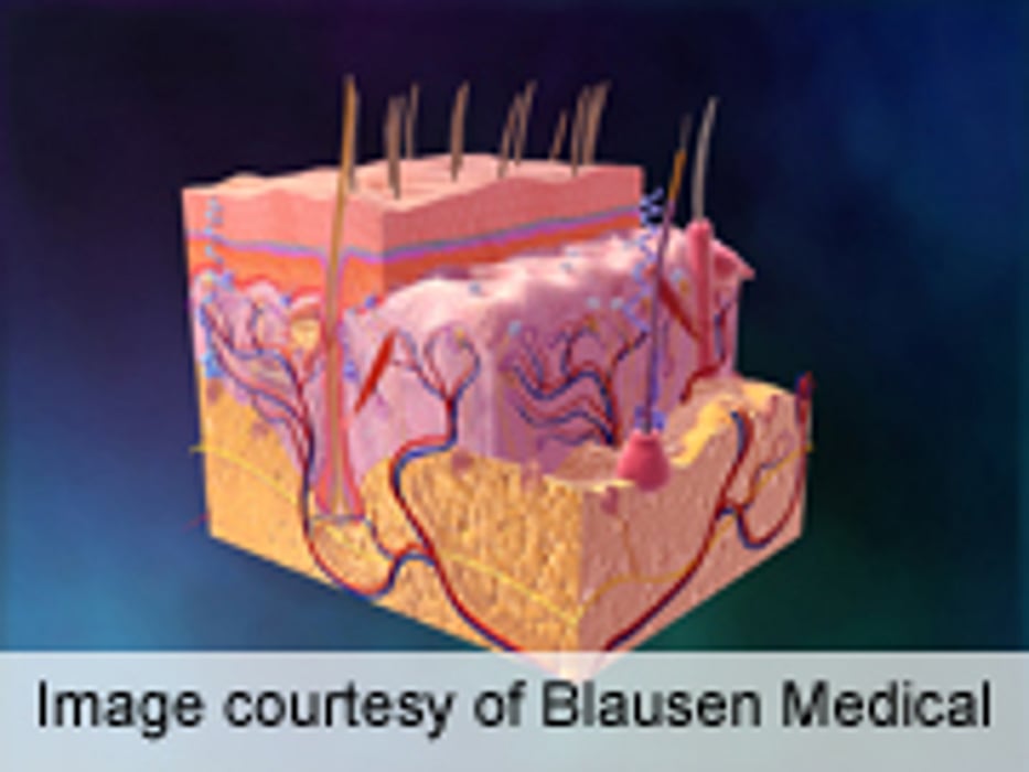 Photodynamic Therapy Beats Cryotherapy For Actinic Keratoses Consumer