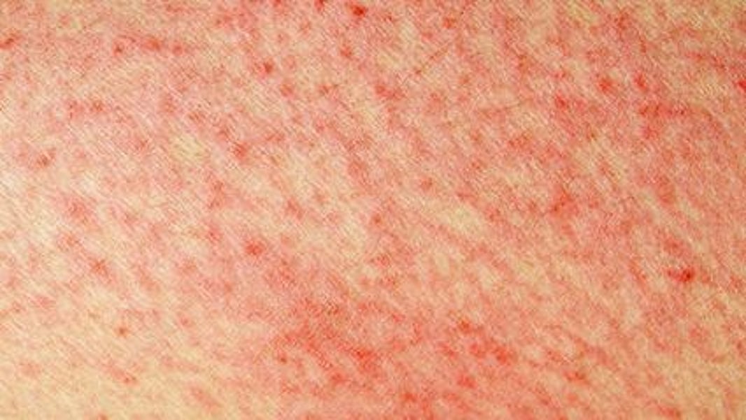 Shingles Prevention - Consumer Health News | HealthDay