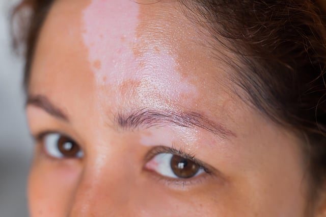 ruxolitinib clears skin of people with vitiligo - Consumer Health News ...